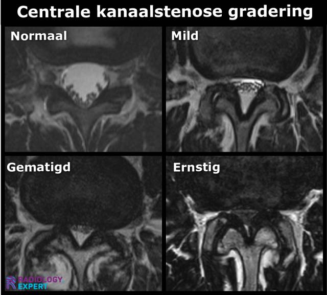MRI lumbale wervelkolom