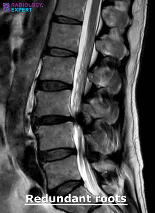 MRI lumbale wervelkolom