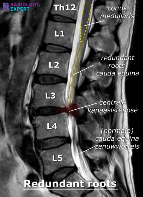 MRI lumbale wervelkolom