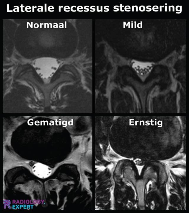 MRI lumbale wervelkolom