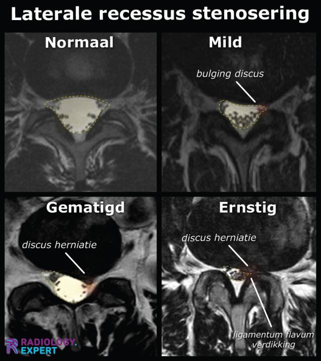 MRI lumbale wervelkolom