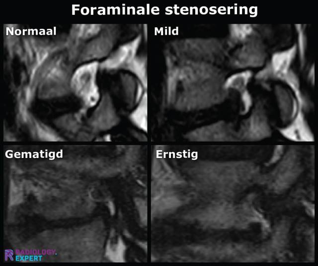 MRI lumbale wervelkolom