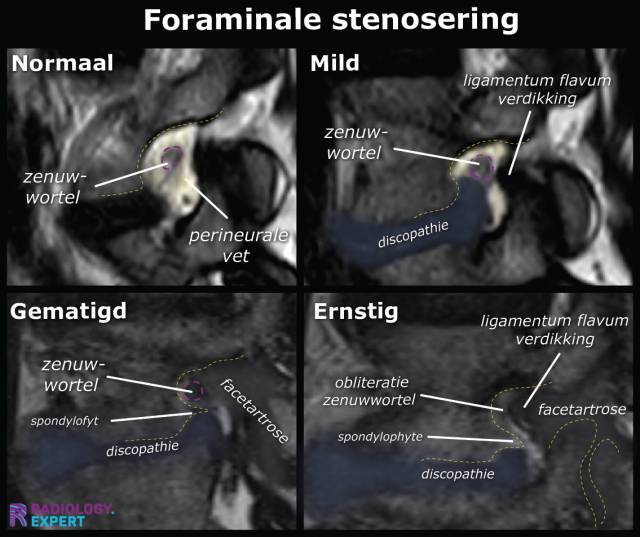 MRI lumbale wervelkolom