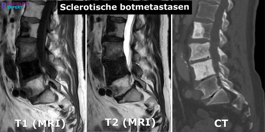 MRI lumbale wervelkolom