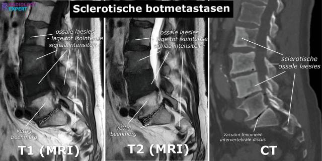 MRI lumbale wervelkolom