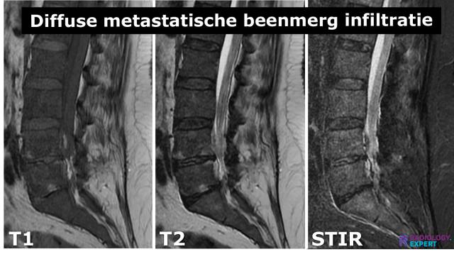 MRI lumbale wervelkolom