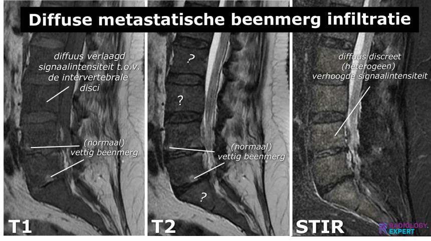 MRI lumbale wervelkolom
