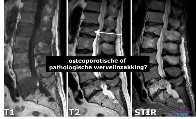 MRI lumbale wervelkolom