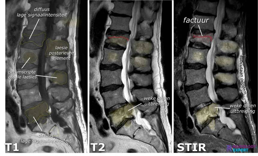 MRI lumbale wervelkolom