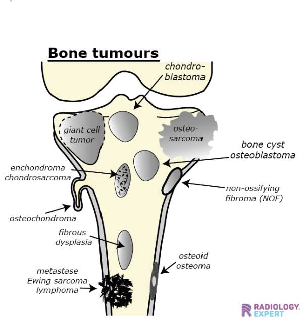 Bone tumours