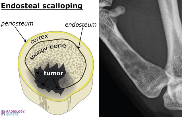 Bone tumours