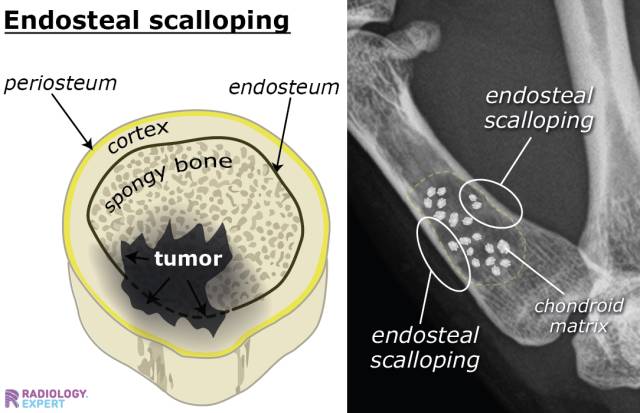 Bone tumours
