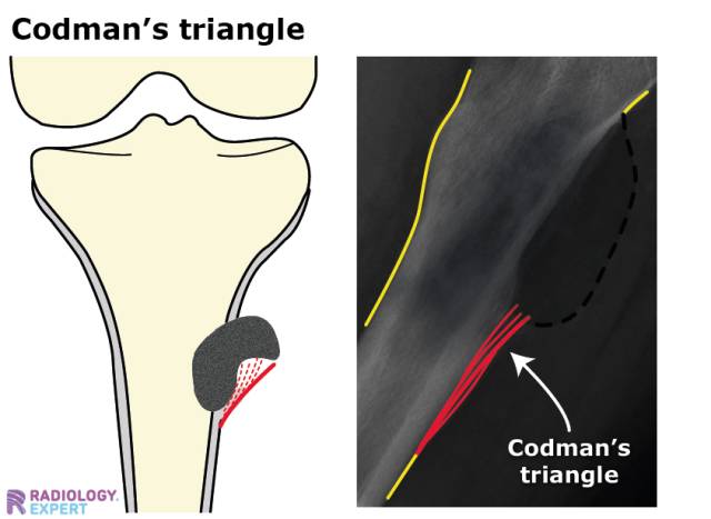 Osteosarcoma Codmans Triangle