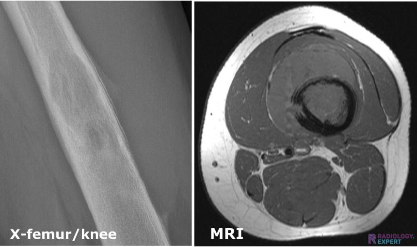 Bone tumours