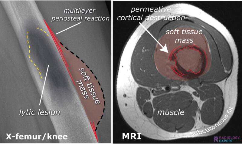 Bone tumours