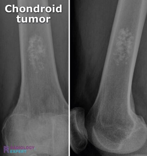 Bone tumours