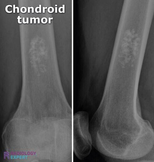 Bone tumours