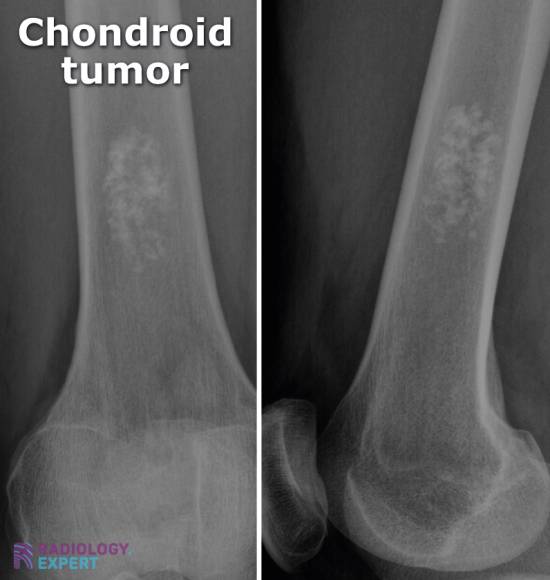 Bone tumours