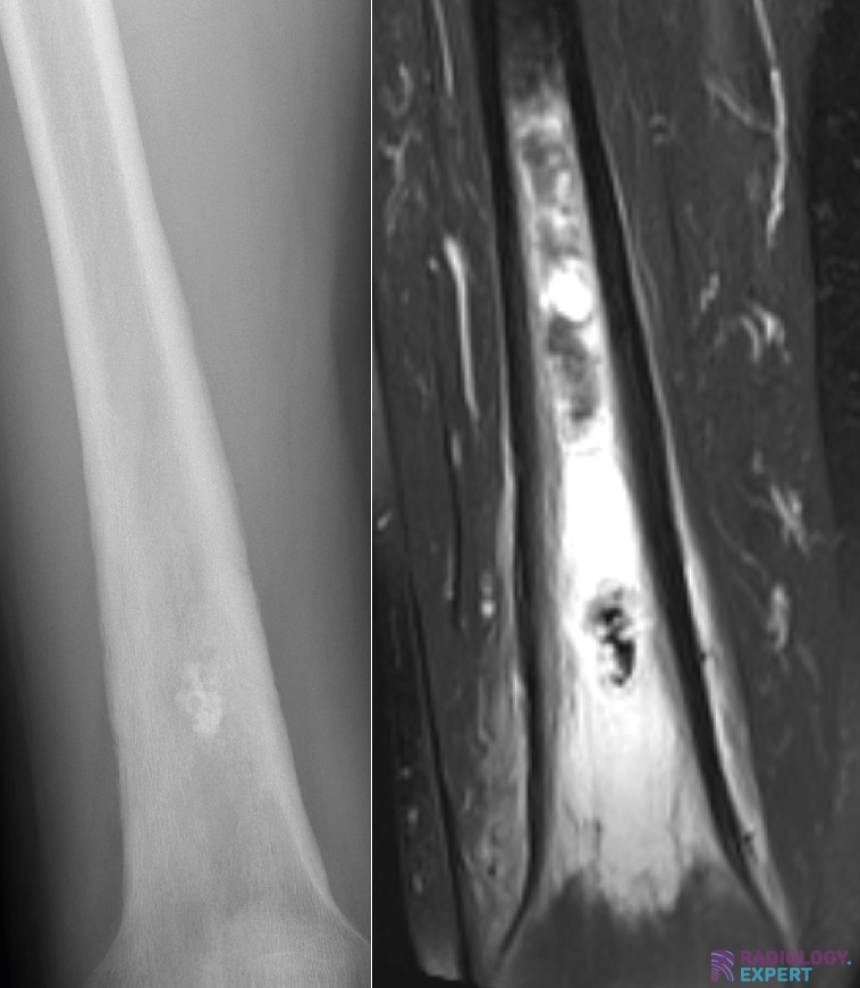 Bone tumours