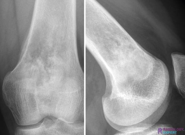 Bone tumours
