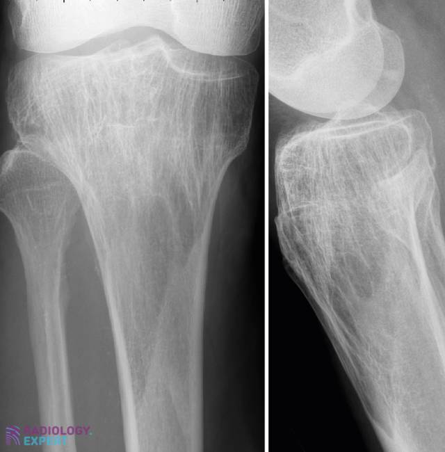 Paget's Disease Tibia Radiology at Marilyn Pierre blog
