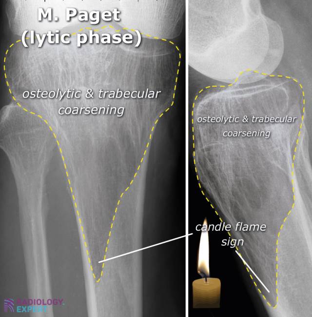 Pathophysiology Of Paget's Disease Of Bone at Elizabeth Knowles blog