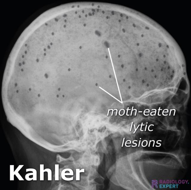 Multiple Myeloma X Ray