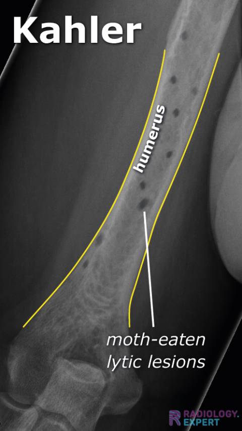 Bone tumours