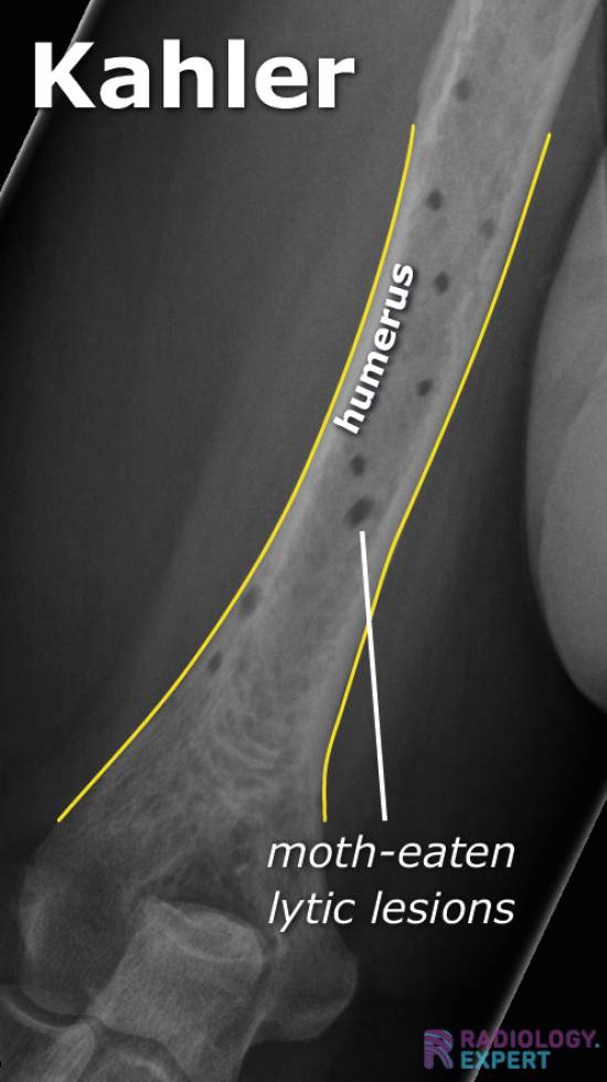 Bone tumours