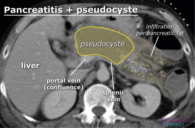 Pancreatic Divisum Radiology