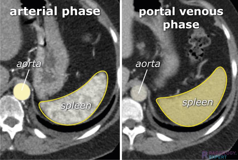 CT abdomen general