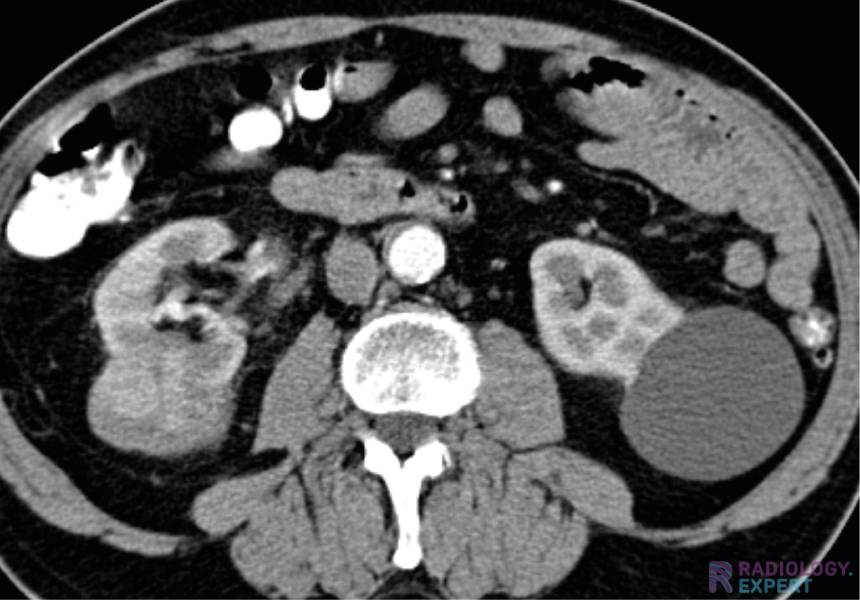 CT abdomen general