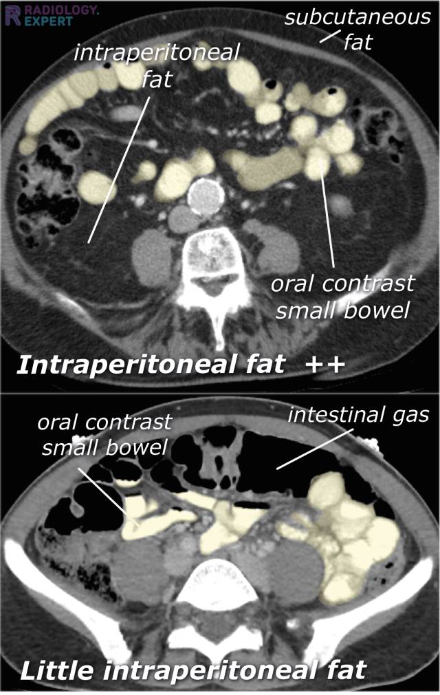 CT abdomen general