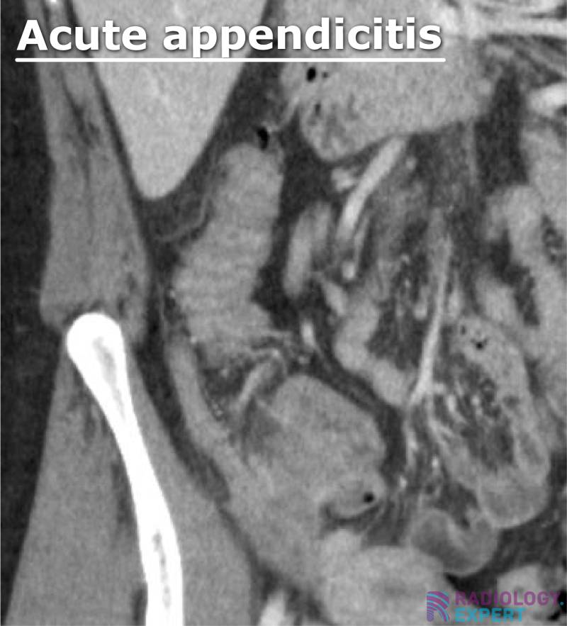 CT abdomen general