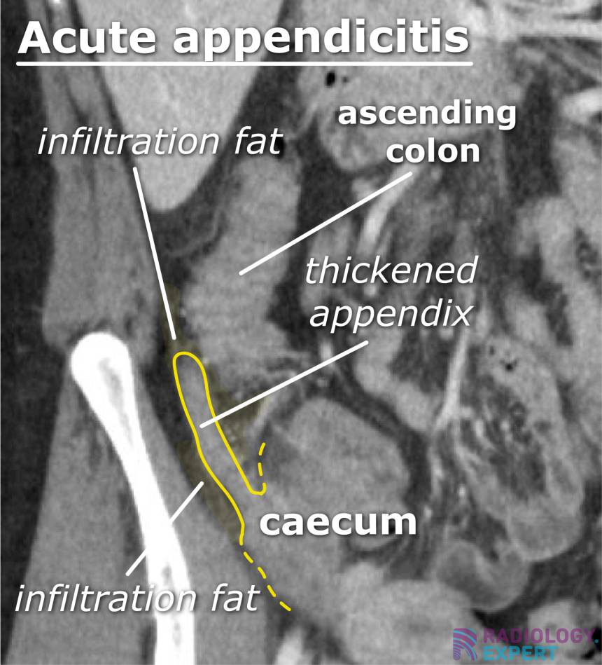 CT abdomen general