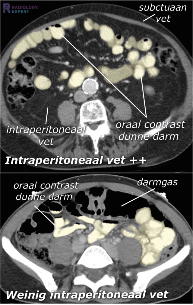 CT abdomen algemeen