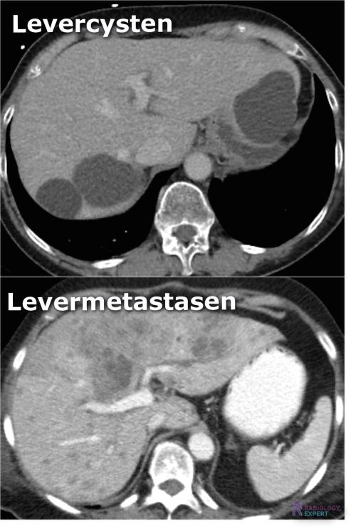 CT abdomen algemeen