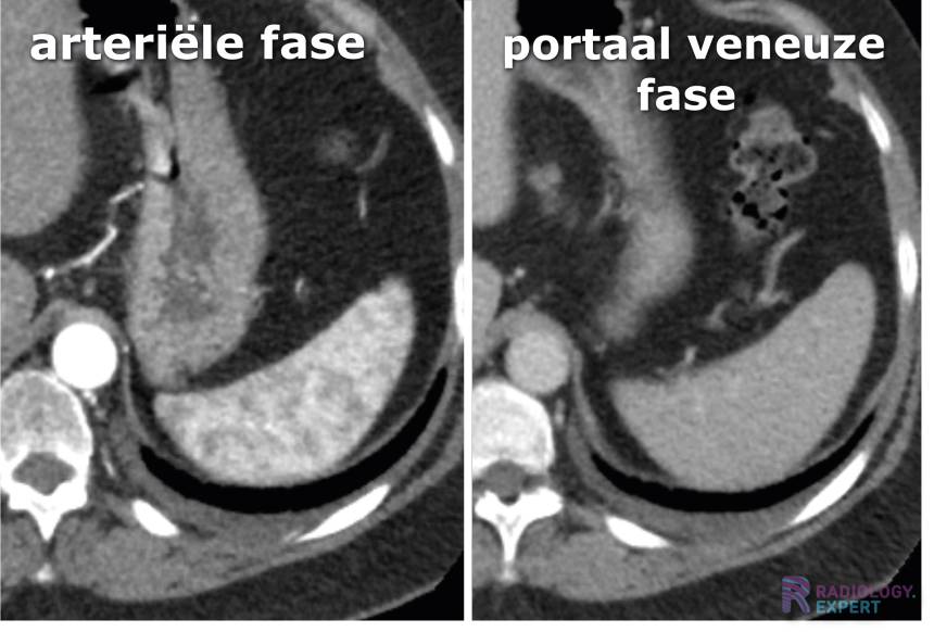 CT abdomen algemeen