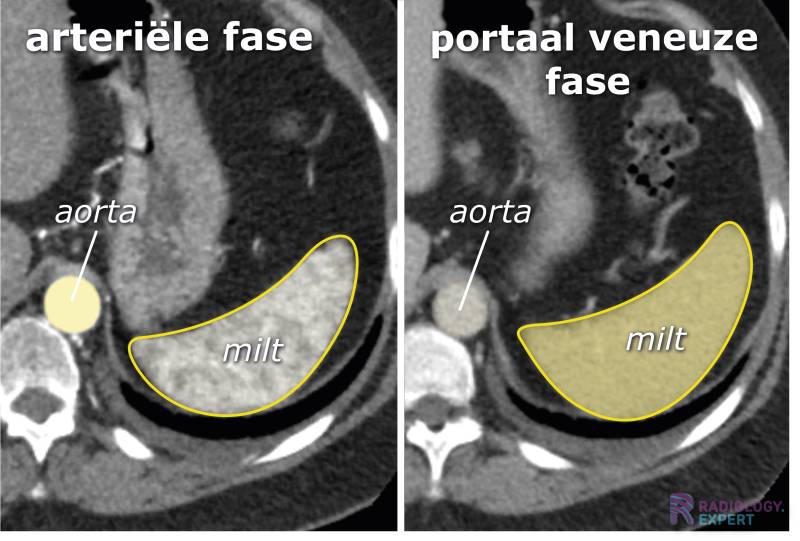CT abdomen algemeen