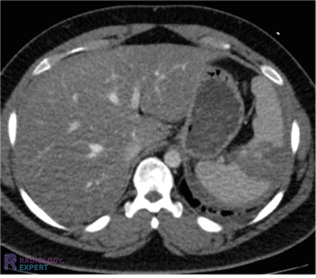 CT abdomen algemeen