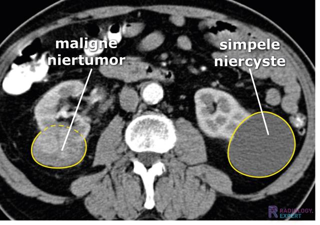 CT abdomen algemeen