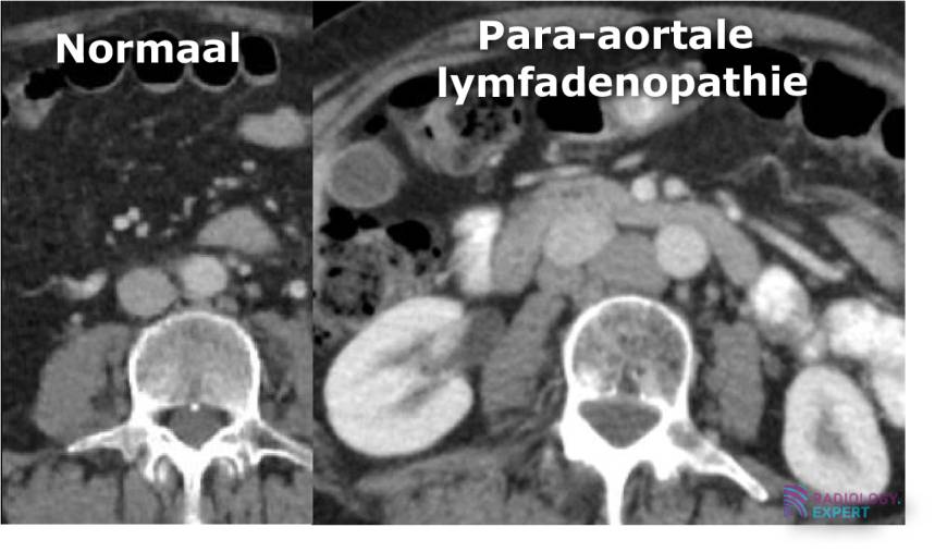 CT abdomen algemeen