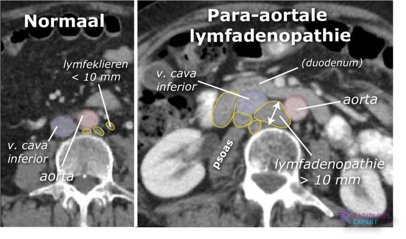CT abdomen algemeen