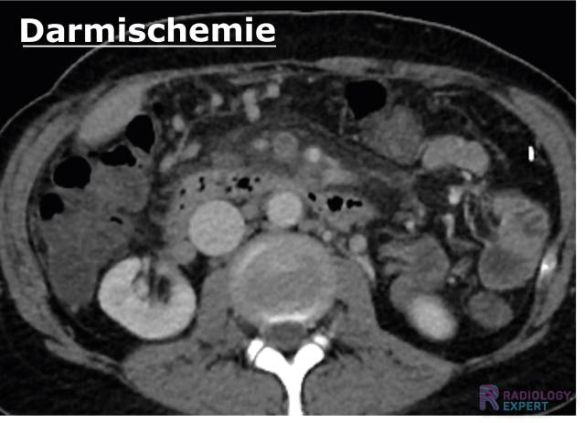 CT abdomen algemeen
