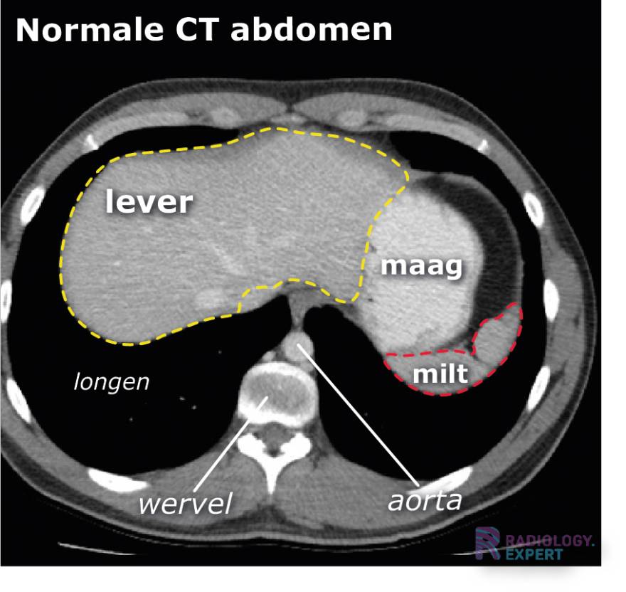 CT abdomen algemeen