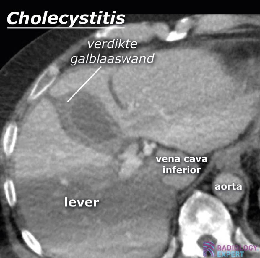 CT abdomen algemeen