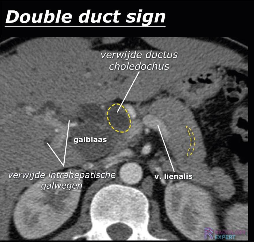 CT abdomen algemeen