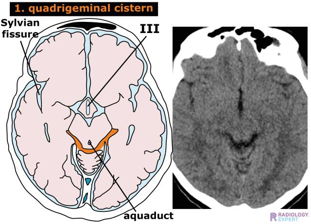 CT brain hemorrhage