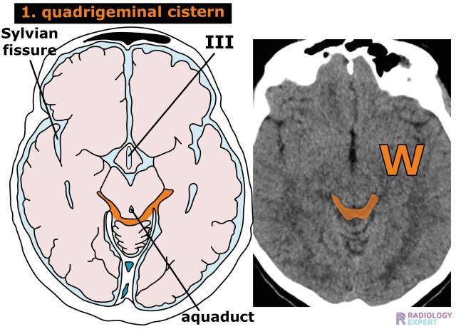 Quadrigeminal Cistern Anatomy