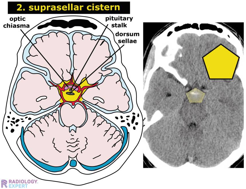 CT brain hemorrhage